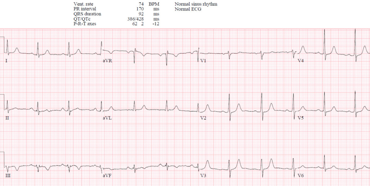 T-wave INVERSION mnemonic | ECG Cases | Emergency Medicine Cases