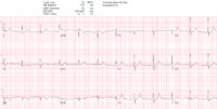 T-wave INVERSION mnemonic | ECG Cases | Emergency Medicine Cases