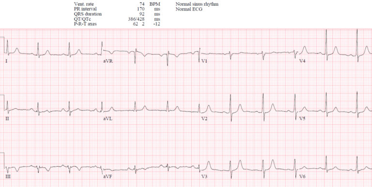 T-wave INVERSION mnemonic | ECG Cases | Emergency Medicine Cases
