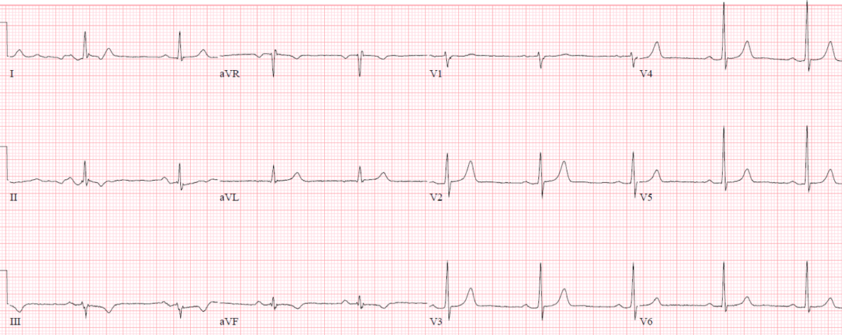 Mnemónico de INVERSIÓN de onda T | Casos de ECG - blogfarmaceutico.com