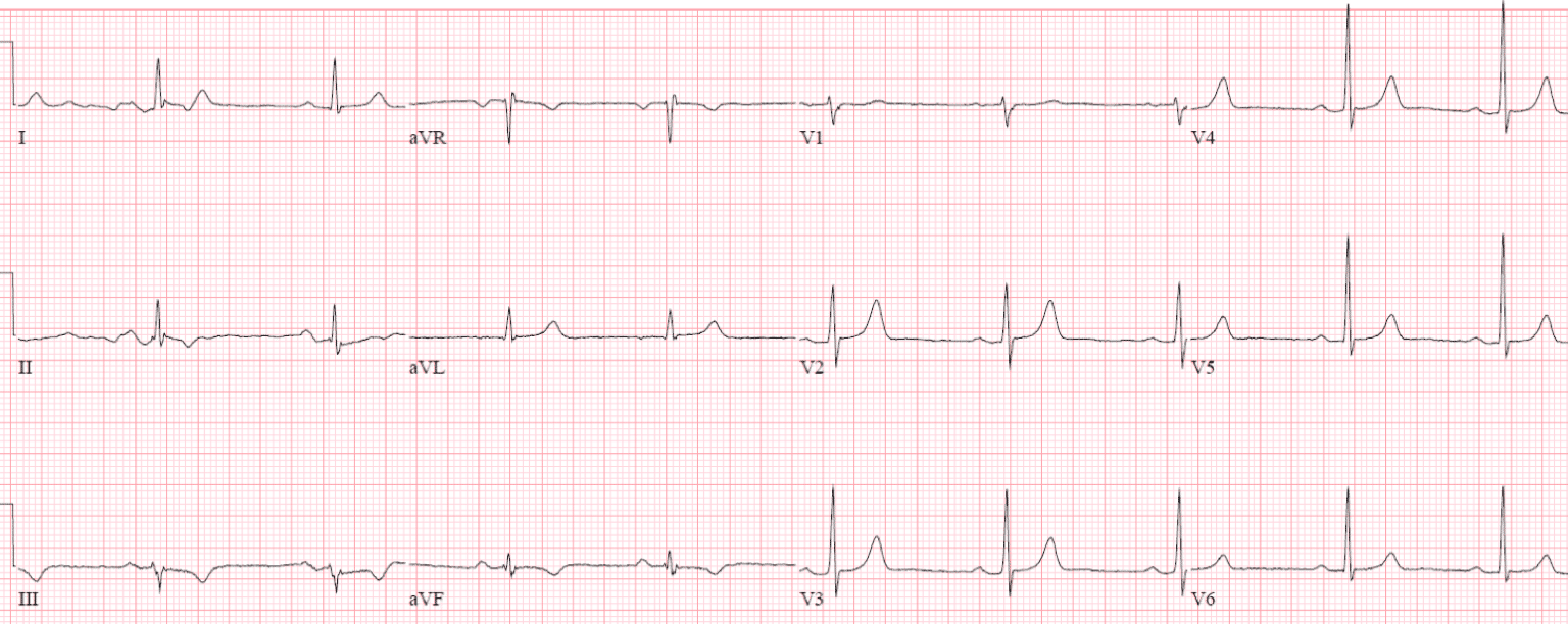T-wave INVERSION mnemonic | ECG Cases | Emergency Medicine Cases