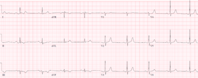 T-wave INVERSION mnemonic | ECG Cases | Emergency Medicine Cases
