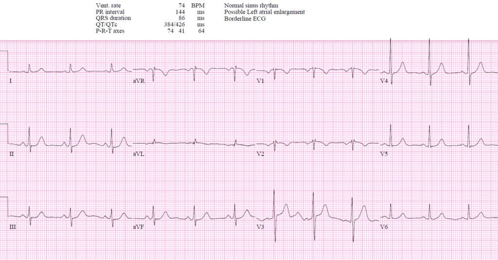 T-wave INVERSION mnemonic | ECG Cases | Emergency Medicine Cases