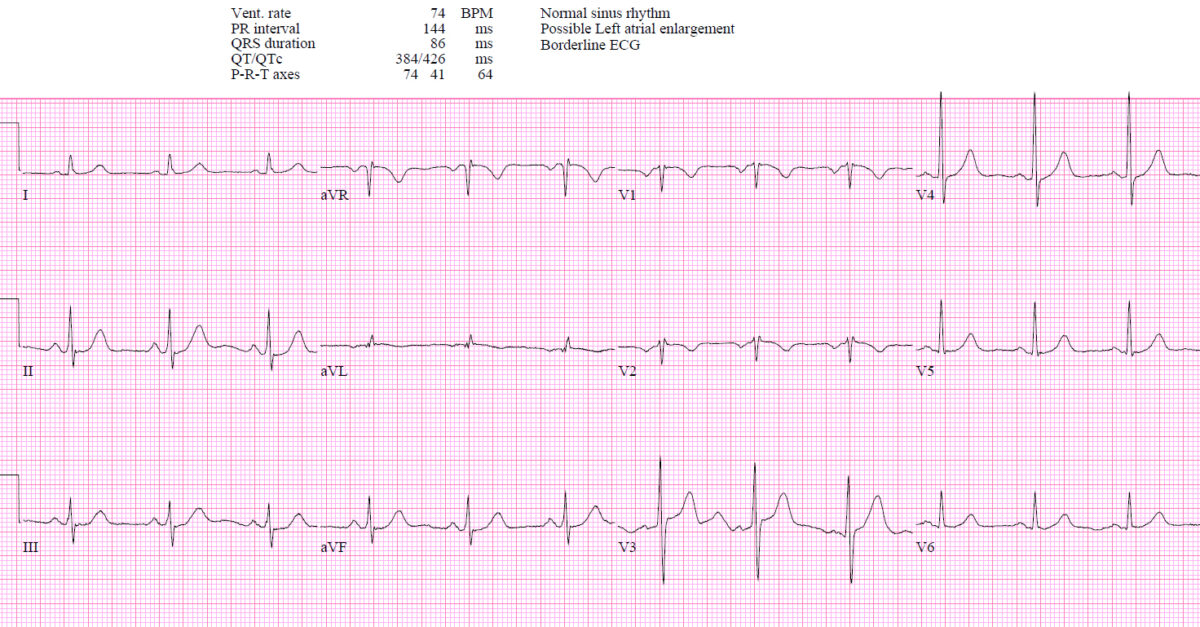 T-wave INVERSION mnemonic | ECG Cases | Emergency Medicine Cases