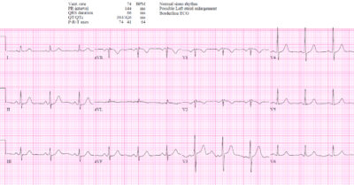 T-wave INVERSION mnemonic | ECG Cases | Emergency Medicine Cases
