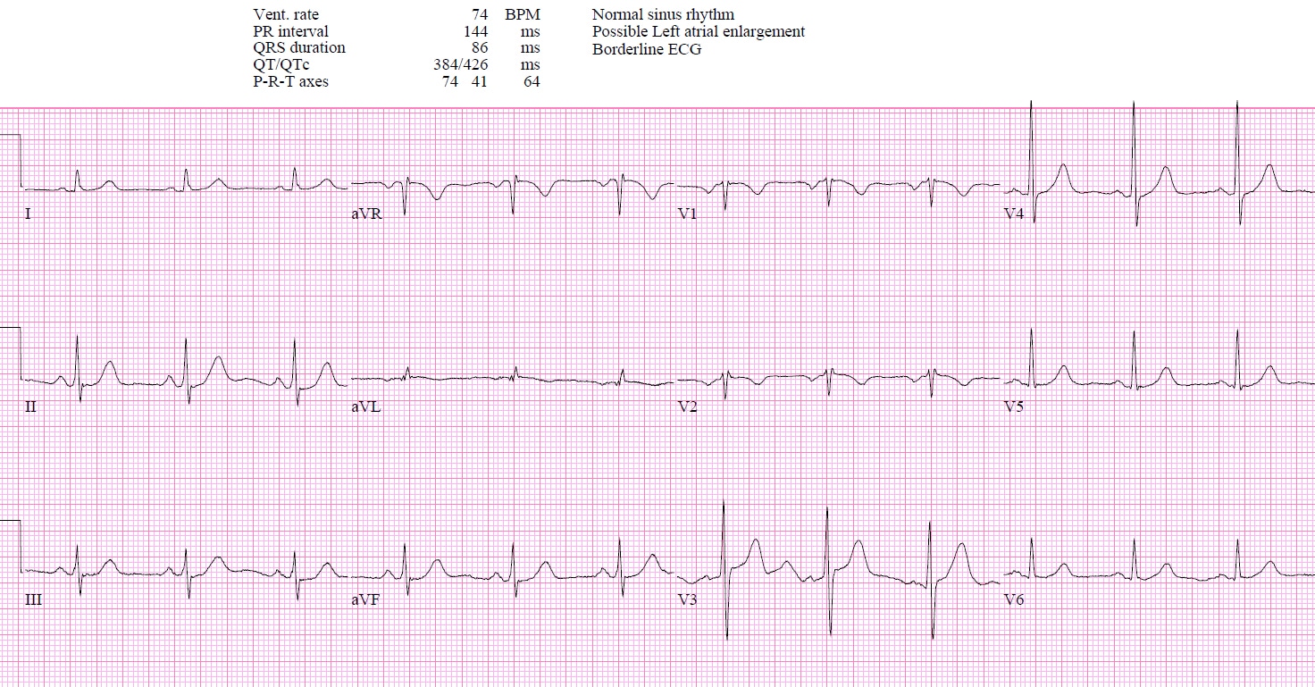 T-wave INVERSION mnemonic | ECG Cases | Emergency Medicine Cases