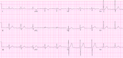T-wave INVERSION mnemonic | ECG Cases | Emergency Medicine Cases