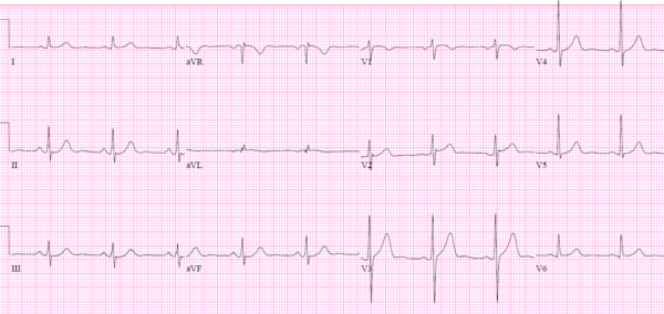 T-wave INVERSION mnemonic | ECG Cases | Emergency Medicine Cases
