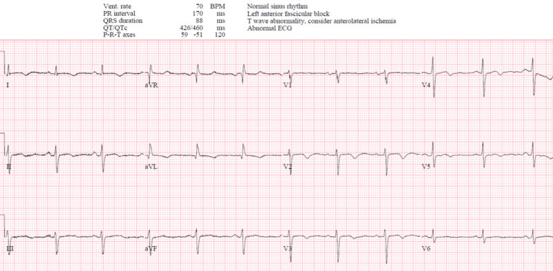 T-wave INVERSION mnemonic | ECG Cases | Emergency Medicine Cases