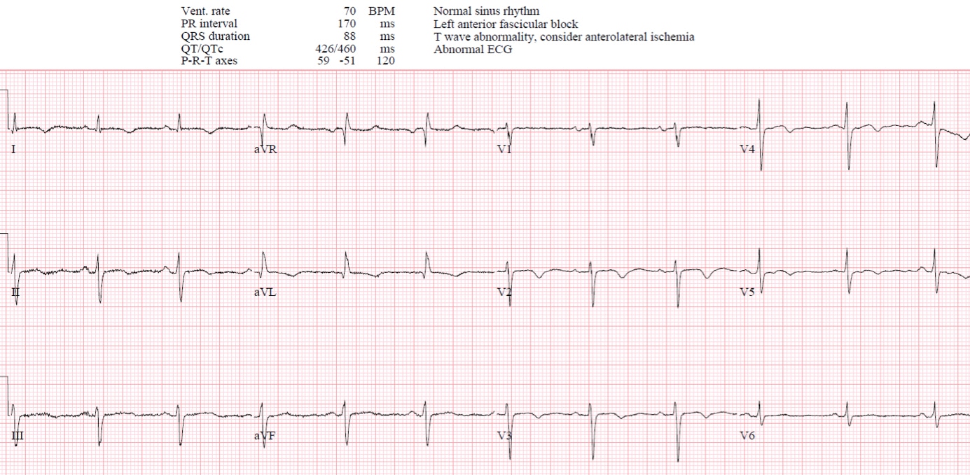 T-wave INVERSION mnemonic | ECG Cases | Emergency Medicine Cases