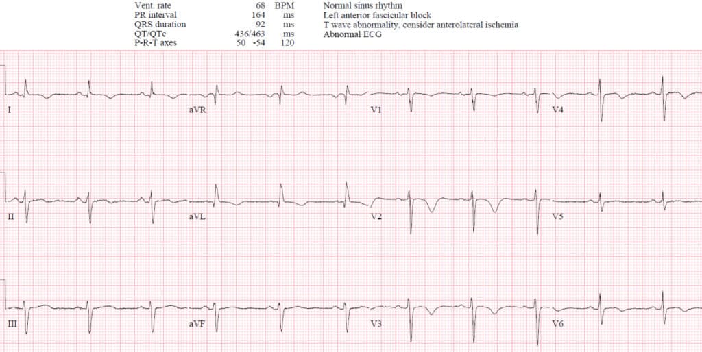 T-wave INVERSION mnemonic | ECG Cases | Emergency Medicine Cases