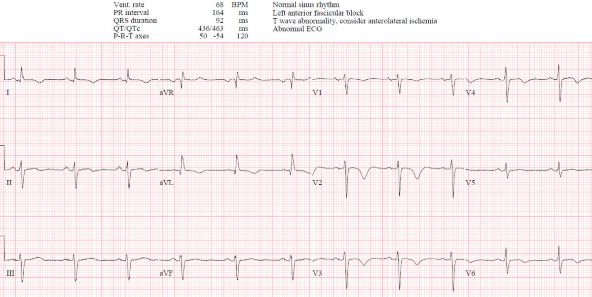 T-wave INVERSION mnemonic | ECG Cases | Emergency Medicine Cases
