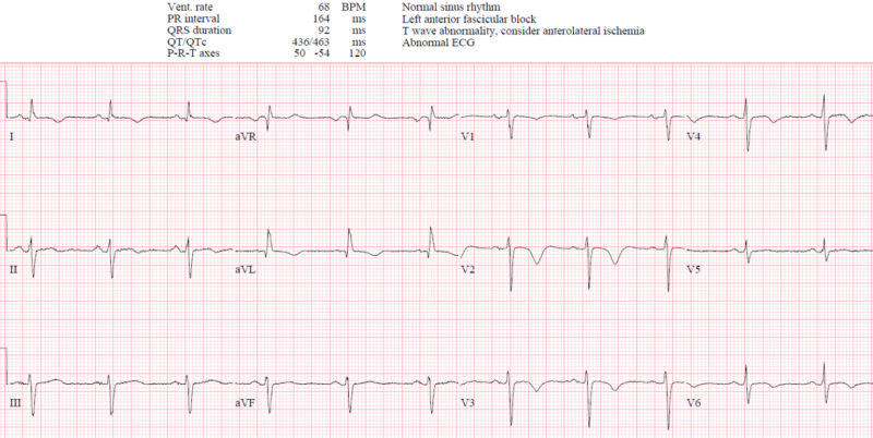 T-wave INVERSION mnemonic | ECG Cases | Emergency Medicine Cases
