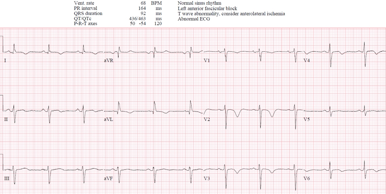 T-wave INVERSION mnemonic | ECG Cases | Emergency Medicine Cases