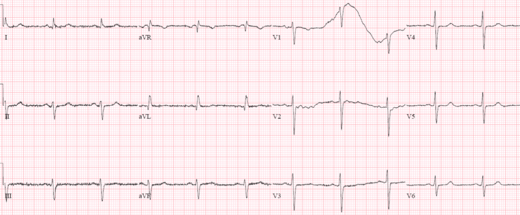 T-wave INVERSION mnemonic | ECG Cases | Emergency Medicine Cases