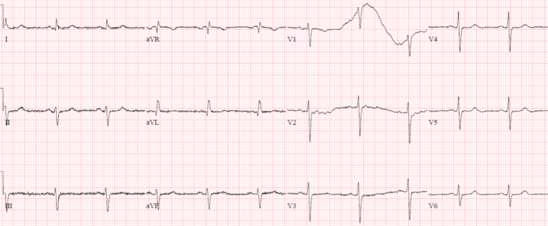 T-wave INVERSION mnemonic | ECG Cases | Emergency Medicine Cases
