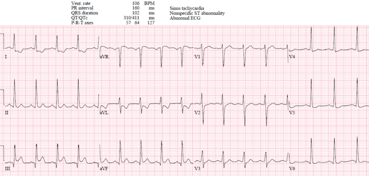 T-wave INVERSION mnemonic | ECG Cases | Emergency Medicine Cases
