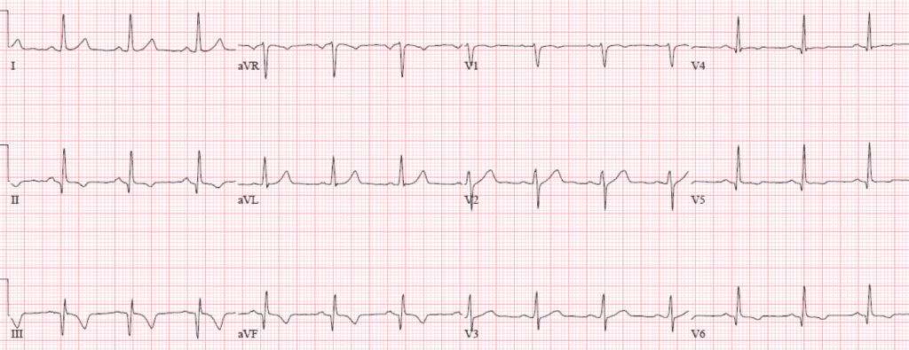 T-wave INVERSION mnemonic | ECG Cases | Emergency Medicine Cases