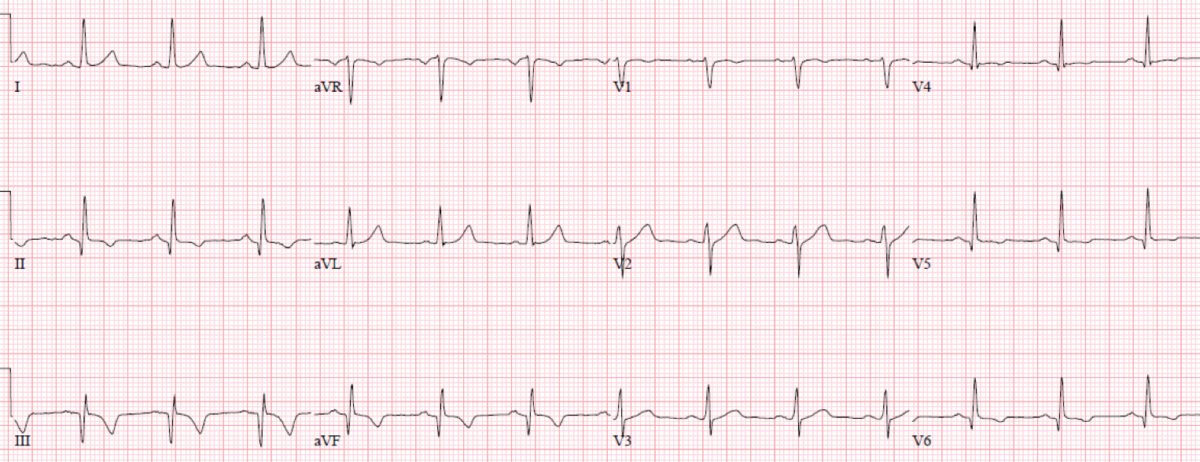 T-wave INVERSION mnemonic | ECG Cases | Emergency Medicine Cases