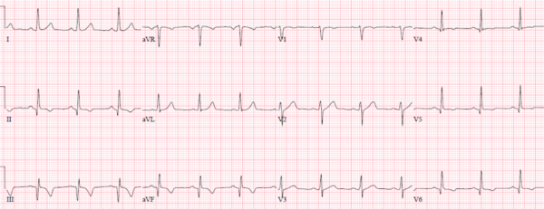T-wave INVERSION mnemonic | ECG Cases | Emergency Medicine Cases