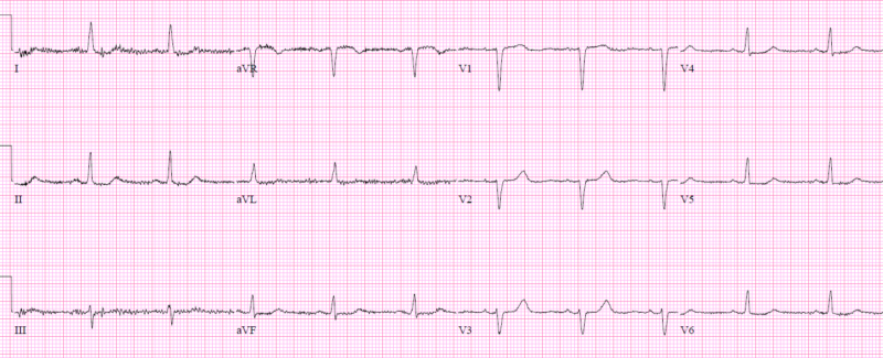 T-wave INVERSION mnemonic | ECG Cases | Emergency Medicine Cases