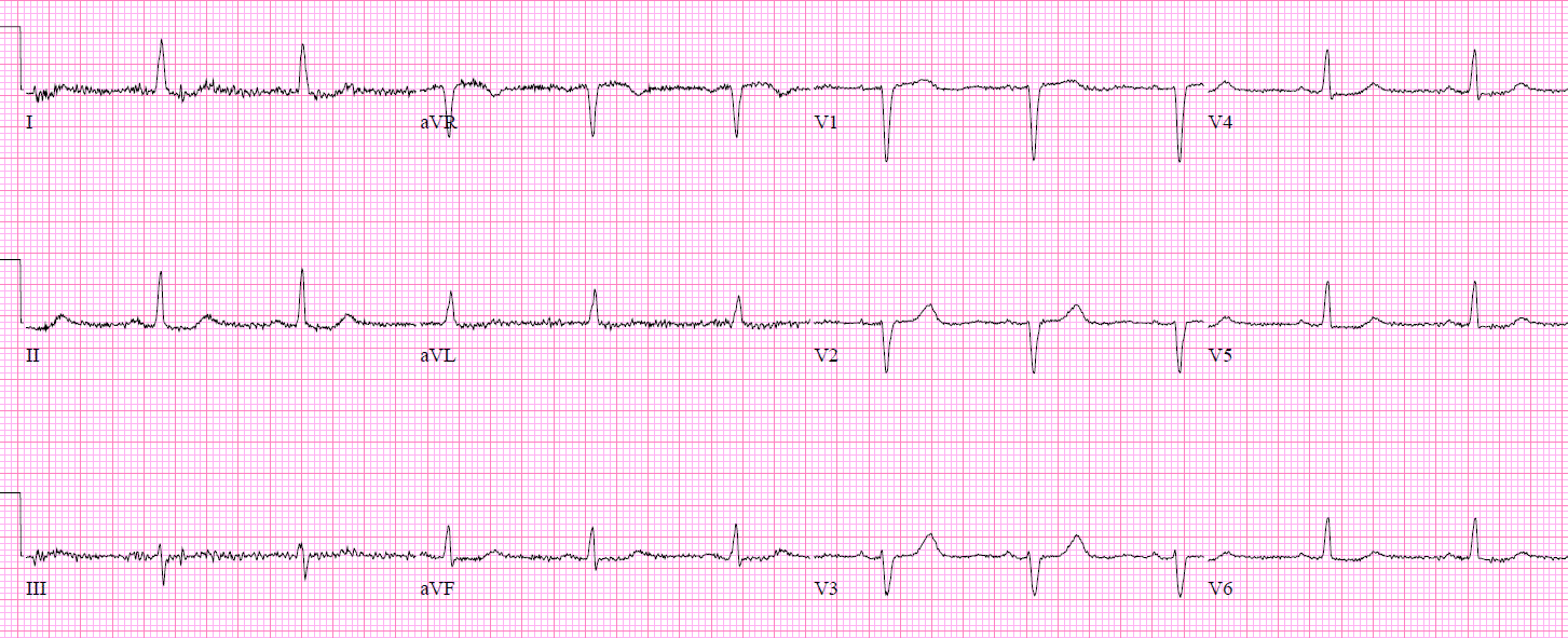 T-wave INVERSION mnemonic | ECG Cases | Emergency Medicine Cases