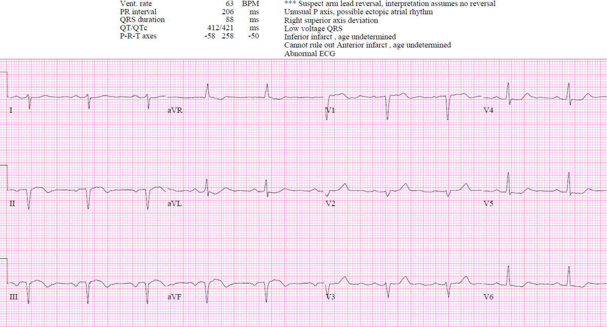 Mnemónico de INVERSIÓN de onda T | Casos de ECG - blogfarmaceutico.com