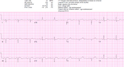 T-wave INVERSION mnemonic | ECG Cases | Emergency Medicine Cases
