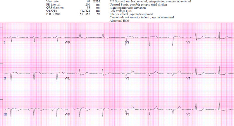 T-wave INVERSION mnemonic | ECG Cases | Emergency Medicine Cases