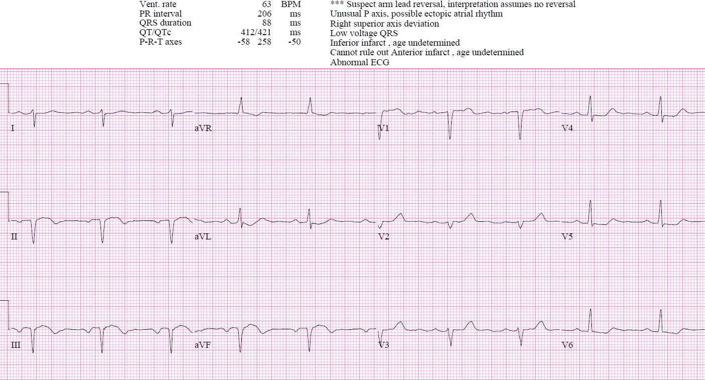T-wave INVERSION mnemonic | ECG Cases | Emergency Medicine Cases T-wave INVERSION mnemonic | ECG Cases | Emergency Medicine Cases