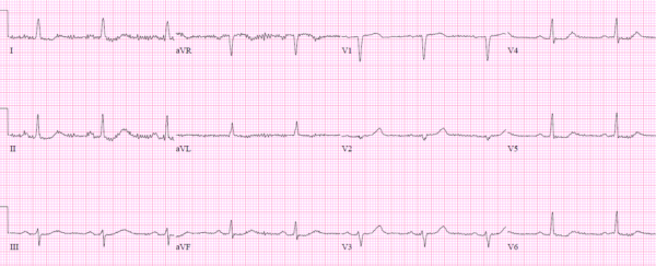 T-wave INVERSION mnemonic | ECG Cases | Emergency Medicine Cases