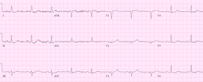 T-wave INVERSION mnemonic | ECG Cases | Emergency Medicine Cases