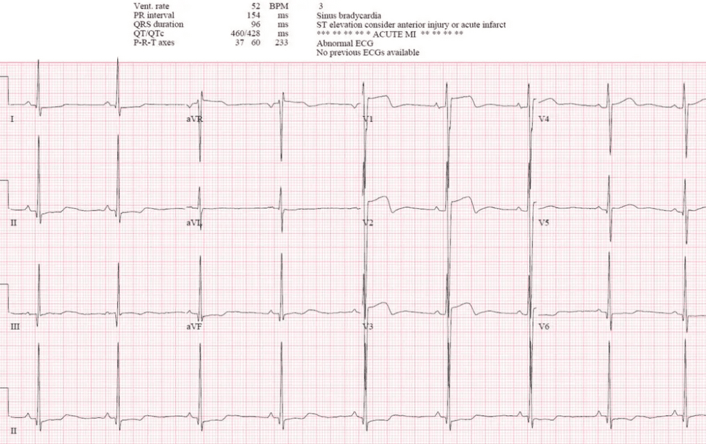 Wellens' syndrome, reperfusion and reocclusion MI | ECG Cases | EM Cases