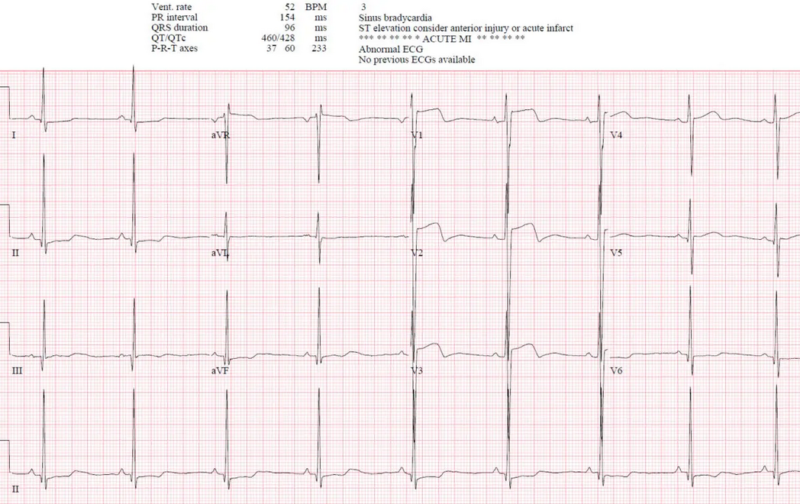Wellens' syndrome, reperfusion and reocclusion MI | ECG Cases | EM Cases