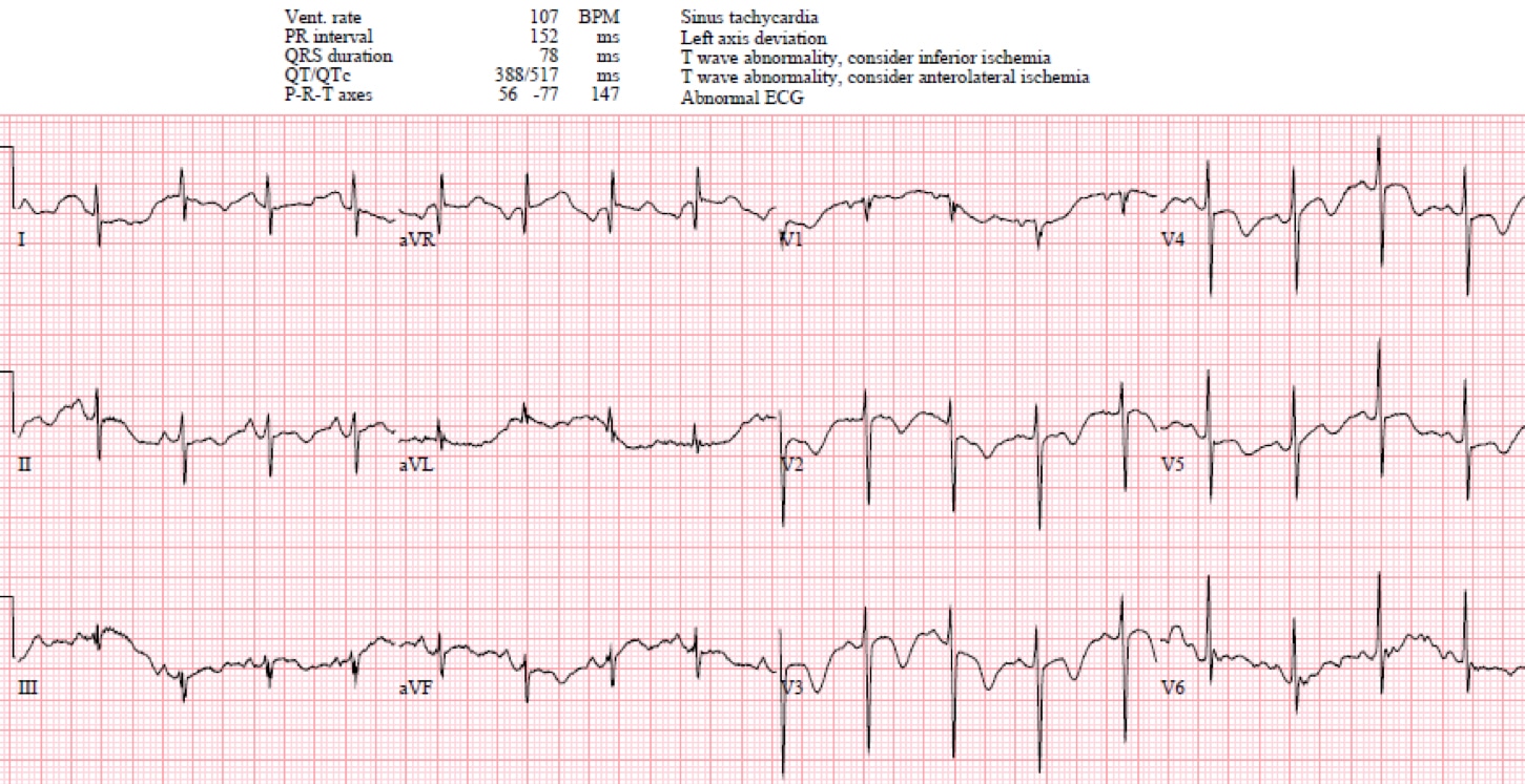 Wellens' syndrome, reperfusion and reocclusion MI | ECG Cases | EM Cases