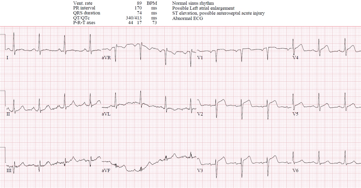 Wellens' syndrome, reperfusion and reocclusion MI | ECG Cases | EM Cases