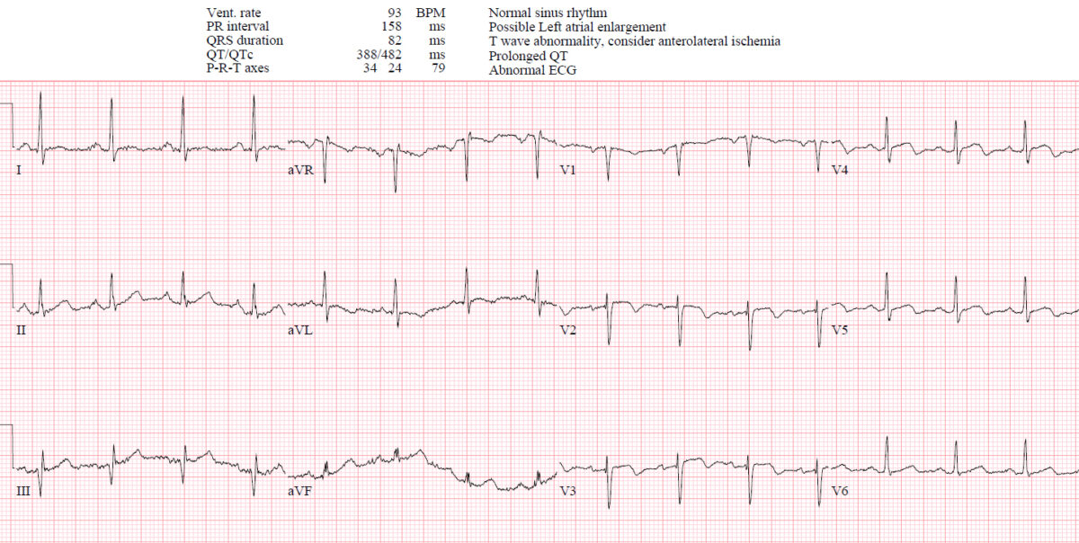 Wellens' syndrome, reperfusion and reocclusion MI | ECG Cases | EM Cases