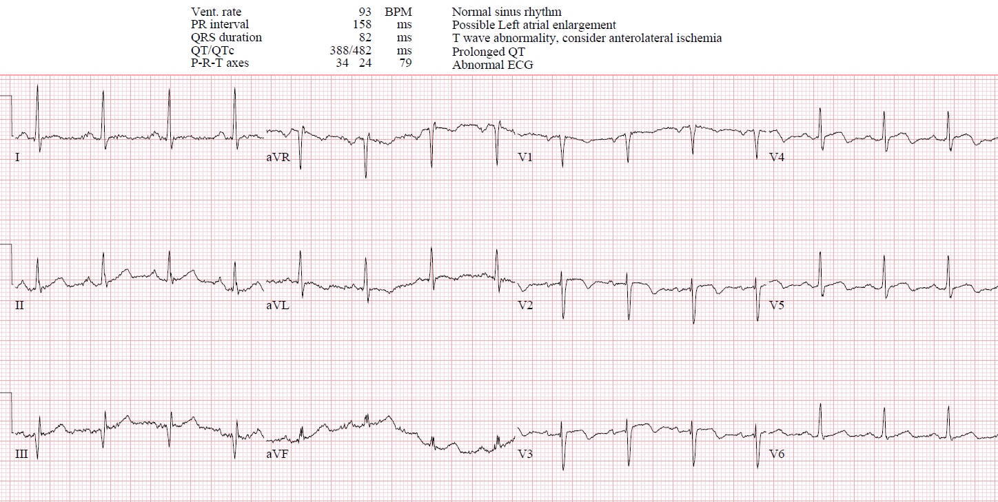 Wellens' syndrome, reperfusion and reocclusion MI | ECG Cases | EM Cases