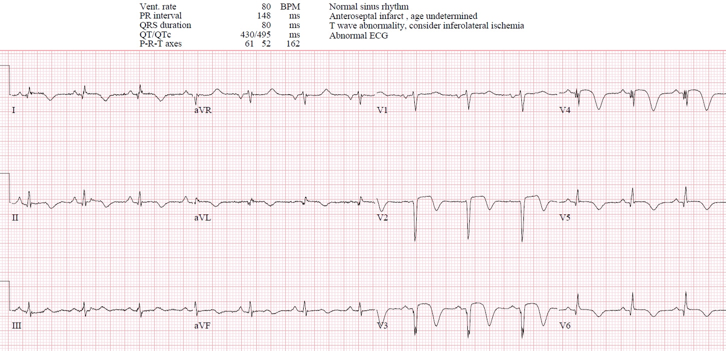 Wellens' syndrome, reperfusion and reocclusion MI | ECG Cases | EM Cases