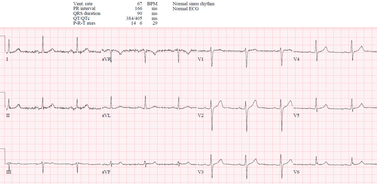 Wellens' syndrome, reperfusion and reocclusion MI | ECG Cases | EM Cases