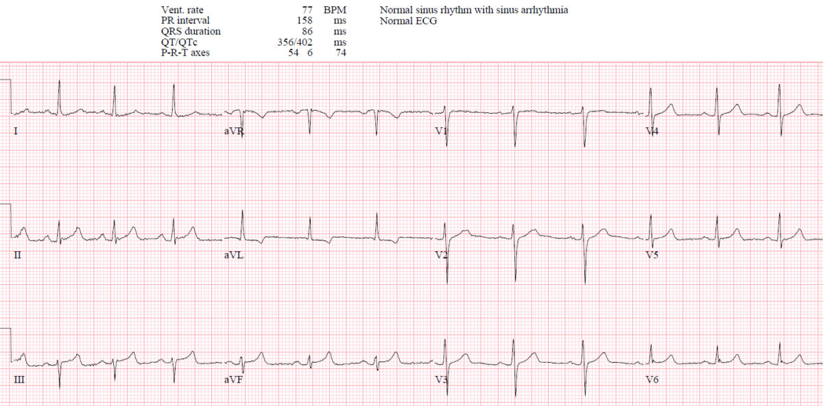 Wellens' syndrome, reperfusion and reocclusion MI | ECG Cases | EM Cases