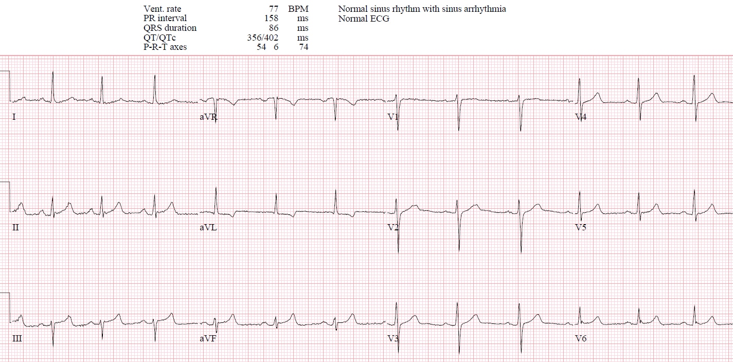Wellens' syndrome, reperfusion and reocclusion MI | ECG Cases | EM Cases