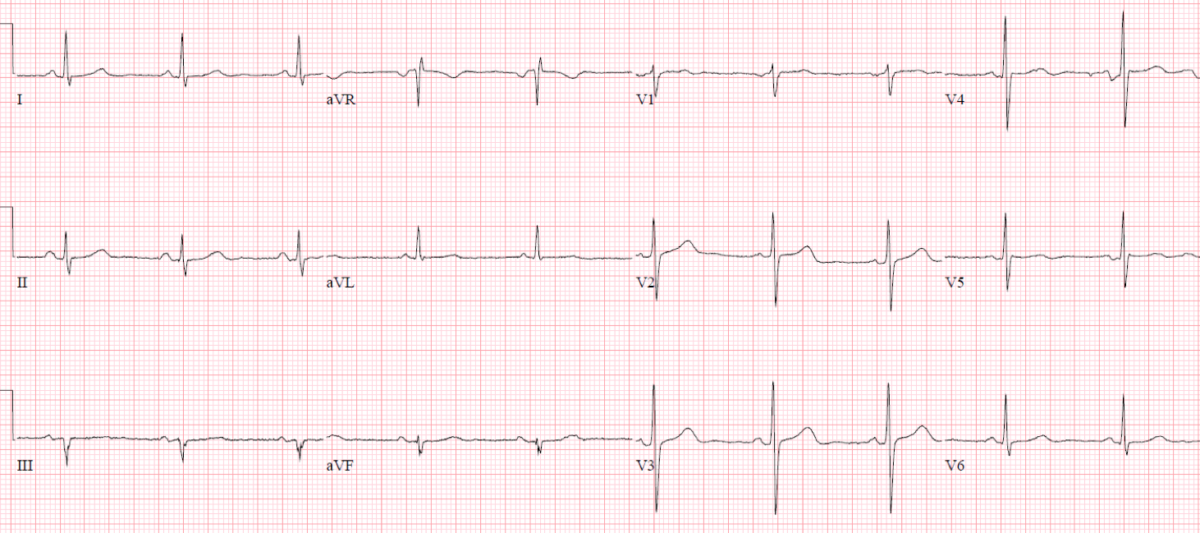 Wellens' syndrome, reperfusion and reocclusion MI | ECG Cases | EM Cases