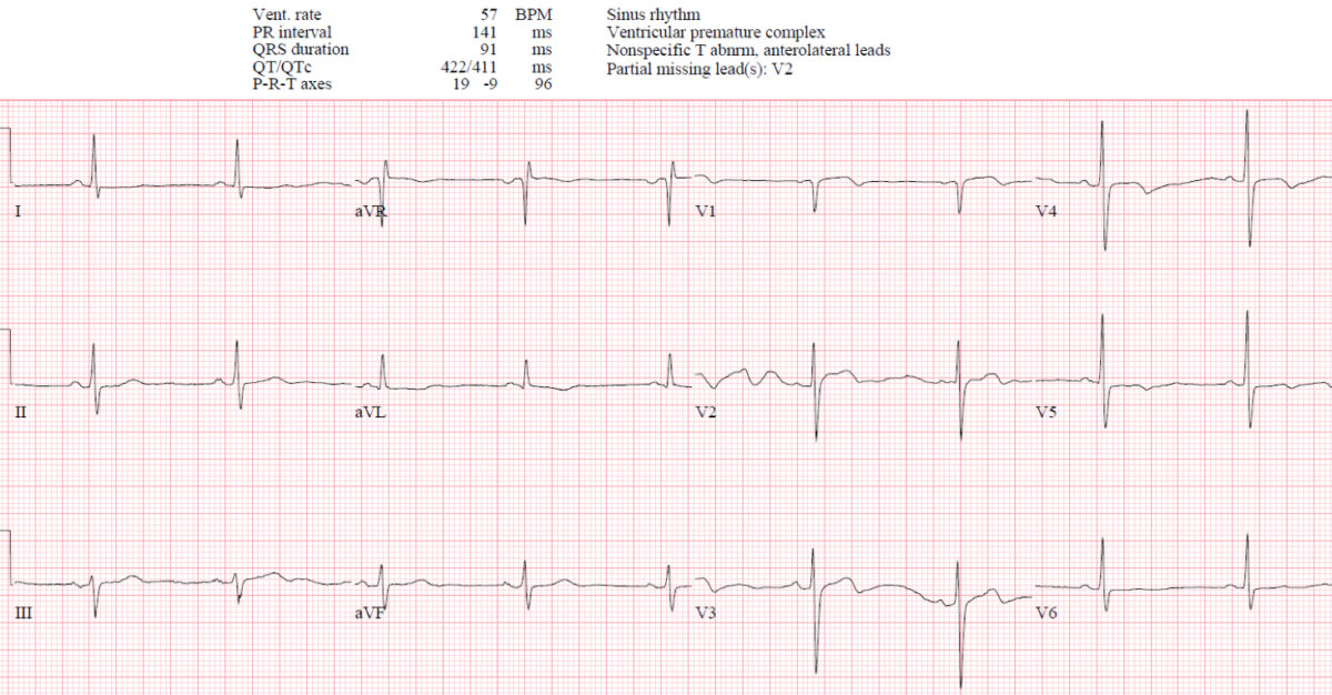 Wellens' syndrome, reperfusion and reocclusion MI | ECG Cases | EM Cases