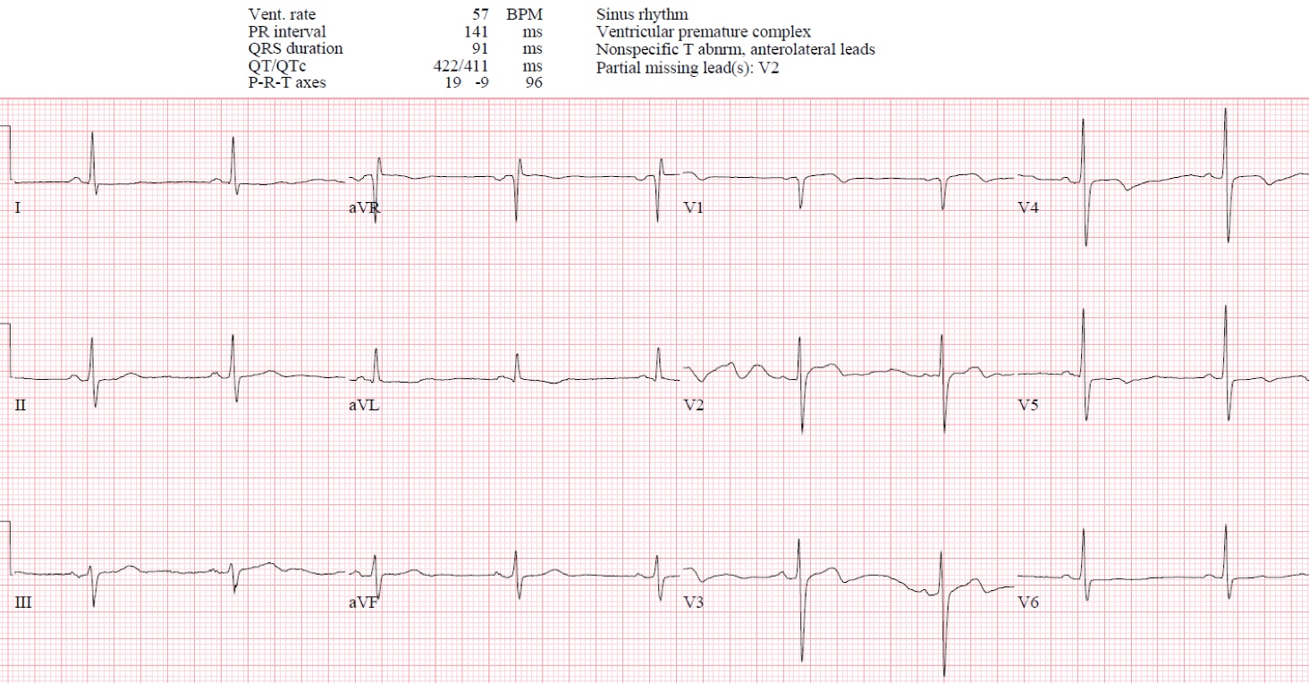 Wellens' syndrome, reperfusion and reocclusion MI | ECG Cases | EM Cases