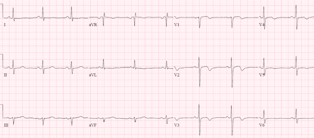 Wellens' syndrome, reperfusion and reocclusion MI | ECG Cases | EM Cases