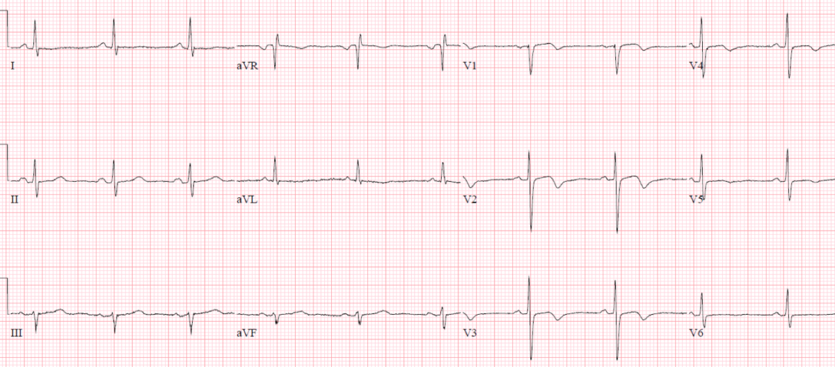 Wellens' syndrome, reperfusion and reocclusion MI | ECG Cases | EM Cases