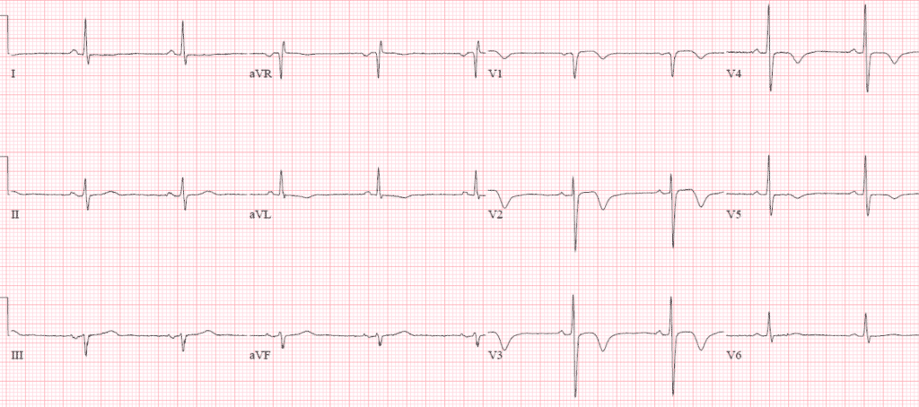 Wellens' syndrome, reperfusion and reocclusion MI | ECG Cases | EM Cases