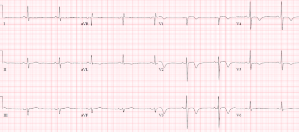 Wellens' syndrome, reperfusion and reocclusion MI | ECG Cases | EM Cases