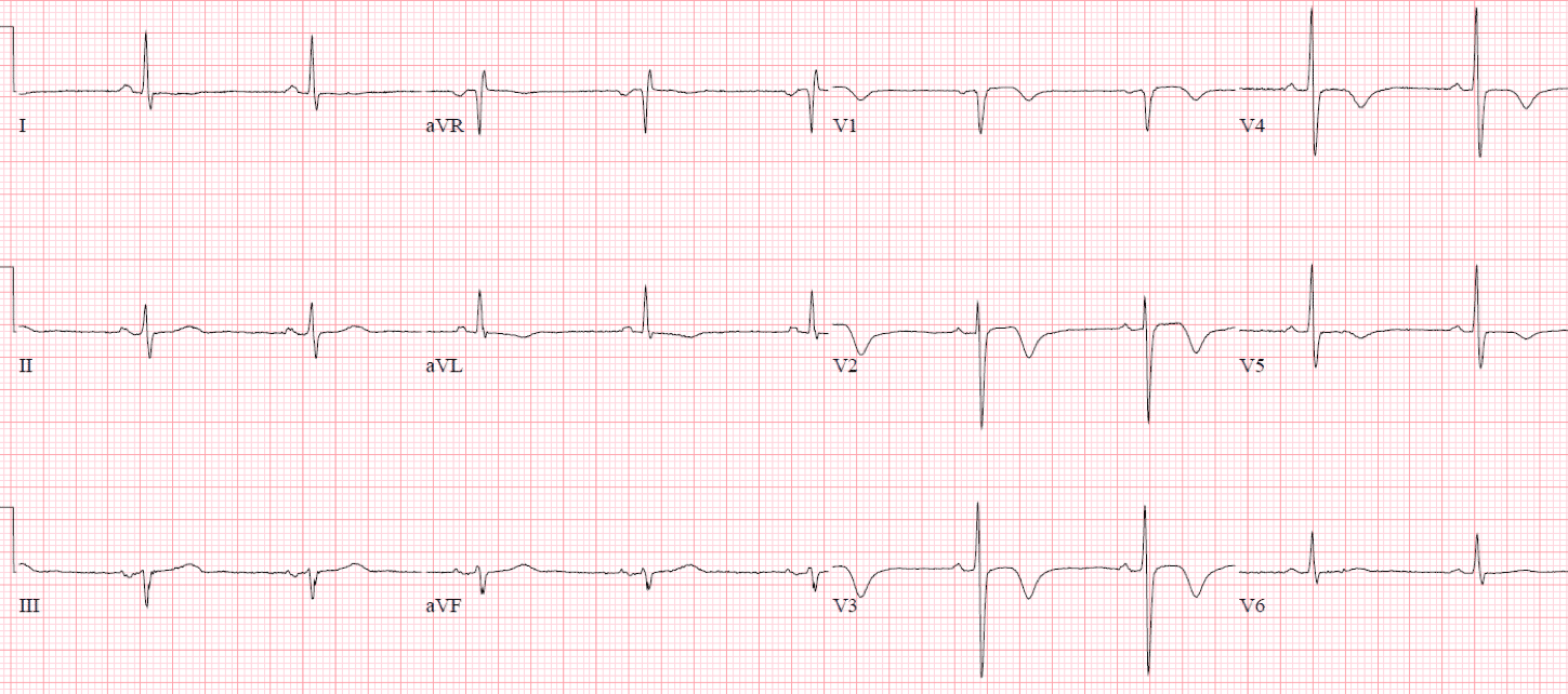 Wellens' syndrome, reperfusion and reocclusion MI | ECG Cases | EM Cases